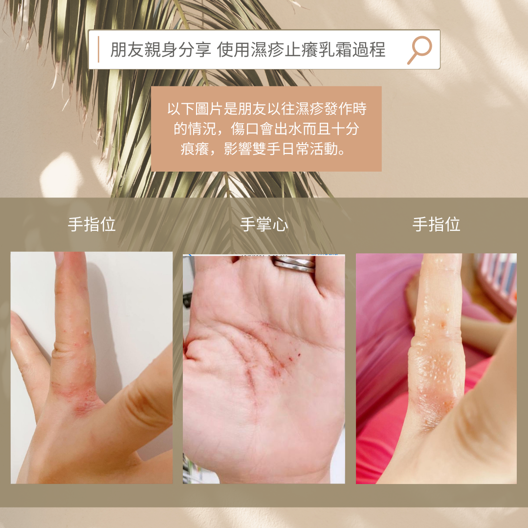 Eczema Anti-Itch Cream 濕疹止癢乳霜 – BETHAN